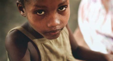 Kwashiorkor And Marasmus Whats The Difference Malnutrition