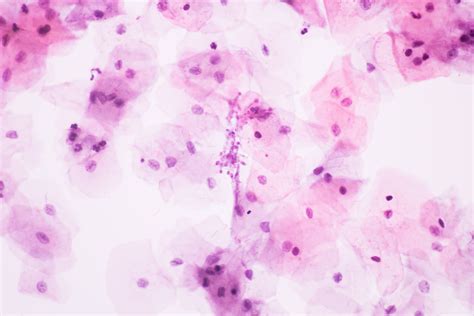 Pap Smear Result Sample Hpv And Cancer Understanding The Link Risks