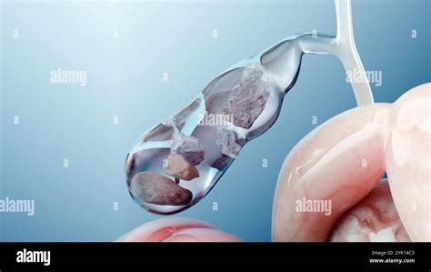Gallstones In The Gallbladderand Bile Duct Human Silhouette And Anatomy Of Surrounding Organs