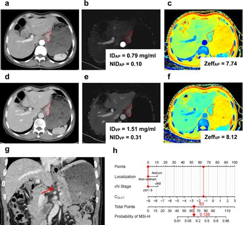 Dual Layer Spectral Detector Ct For Predicting Microsatellite