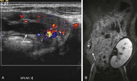 Pancreatic Transplantation Imaging Radiology Key