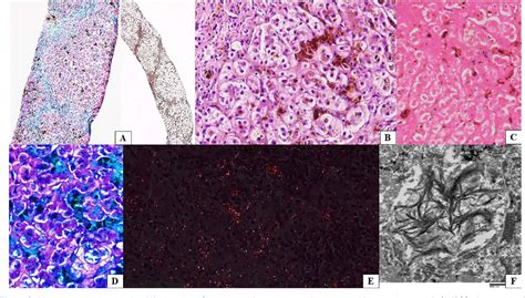 figure 3 from an enigmatic case of jaundice and photosensitivity in an
