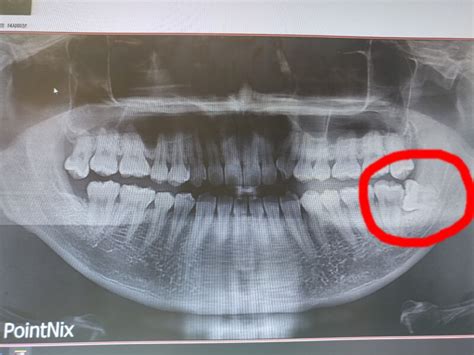 사랑니 레전드 사랑니 발치와 사랑니에 대한 모든 것 총정리