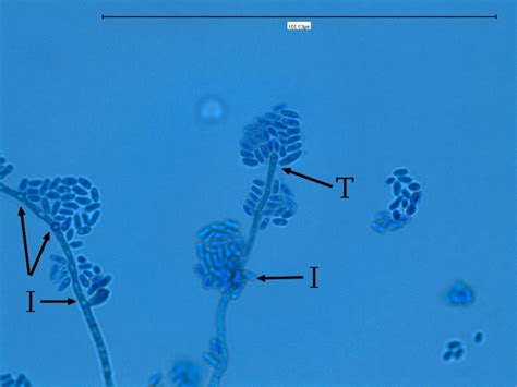 Fun With Microbiology Whats Buggin You Exophiala Dermatitidis