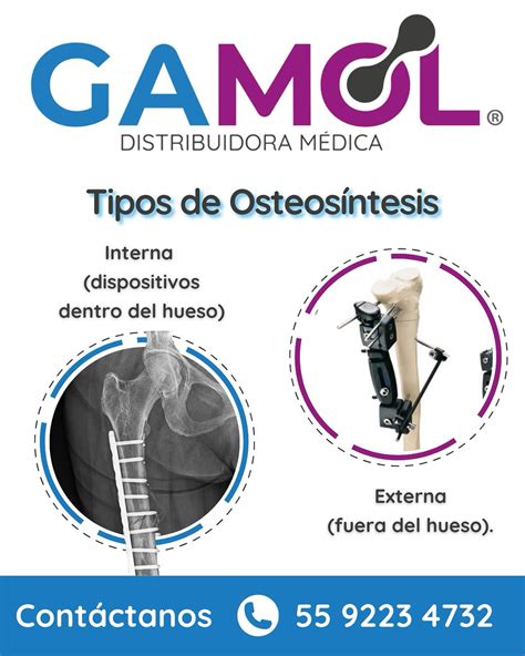Gamol ¿sabías Que Existen Dos Tipos De Osteosíntesis En Gamol Te Orientamos Para Que Conozcas