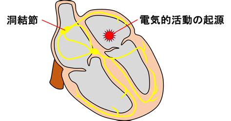 異所性心房調律とは？ 心電図com