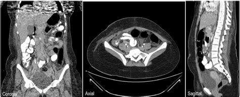 Chest Abdomen And Pelvis Ct Scan With Oral And Iv Contrast Postop Day 5