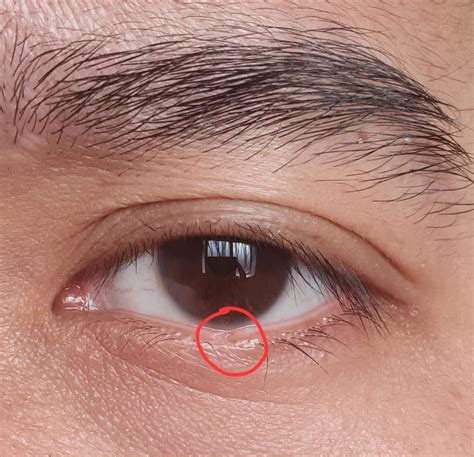 How Do I Fix My Stye Scar R Blepharitis