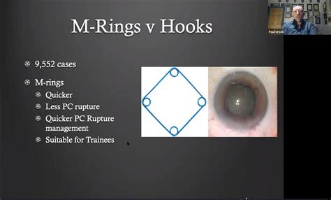 Making A Case Iris Hooks Vs Malyugin Ring By Microsurgical
