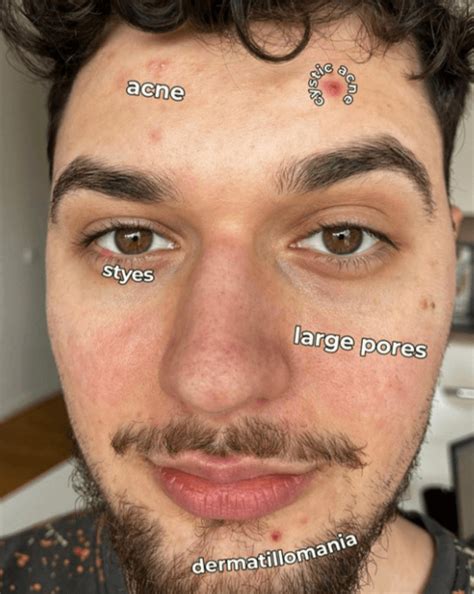 15 Effective Ways To Get Rid Of Acne Scars