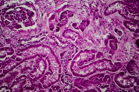 Diffuse Sclerosing Glomerulonephritis Stock Image Image Of Genitourinary Micro 169283815