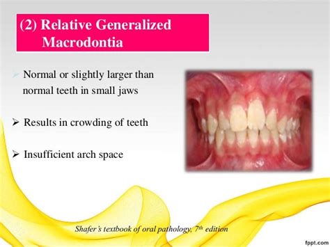 Developmental Anomalies Of Teeth Pptx