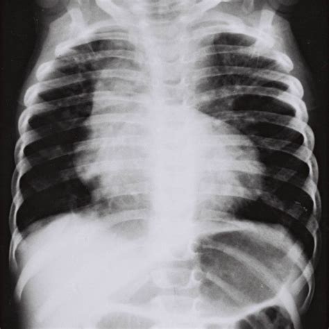 Patients With Congenital Rib Abnormalities And Scoliosis Download