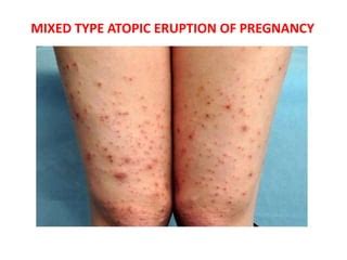 Pregnancy Dermatoses Ppt