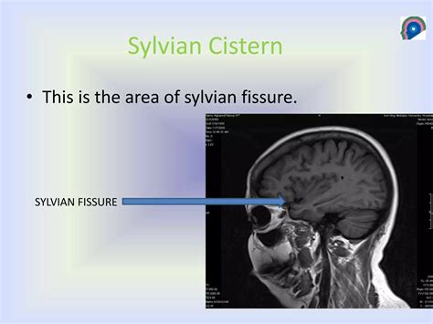Cisterns Of Brain Ppt