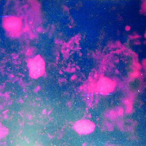 Photomicrograph Of Dna Of A Lysed Cell Of Patient With Clinically