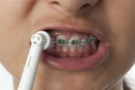 Conventional Braces Vs Self Ligating Braces Which Is Best For You