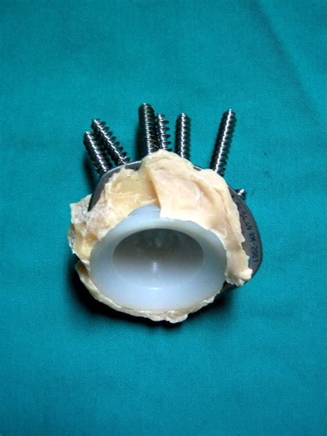 Artroscopia y Artroplastia Prótesis de cadera