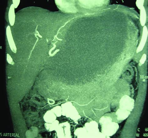 Coronal Maximum Intensity Projection Computed Tomography Angiography
