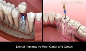 Dental Implants Vs Root Canal And Crown Which Is Better Dentistry