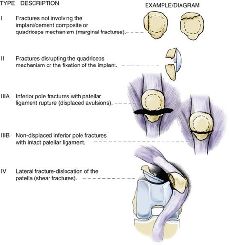 Knee Imaging Techniques And Normal Anatomy Musculoskeletal Key