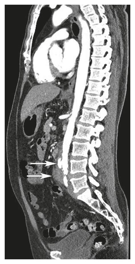 A Transverse View Of Abdominal Ct Shows Periaortic Soft Tissue
