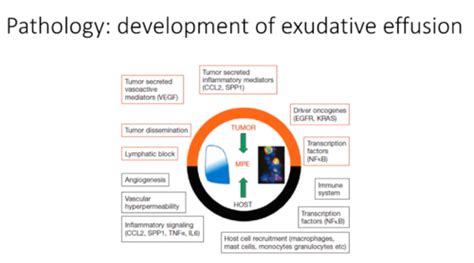 Pleural Malignancy Flashcards Quizlet