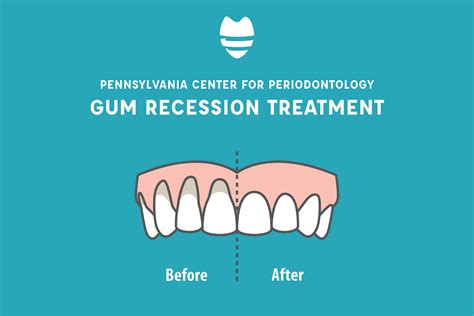 Treatment Of Gum Recession Periodontist In Enola And Camp Hill Area