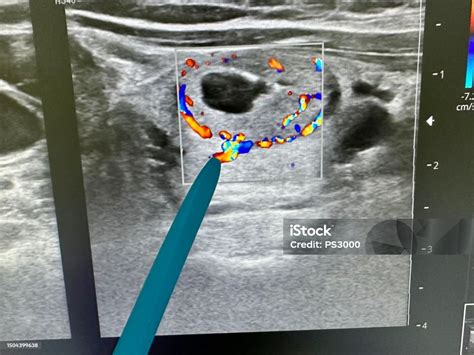 Duplex Ultrasound Scan Of Human Thyroid Gland With Regressiv Thyroid Nodule Imaging Technique