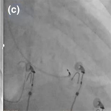Qrs Detection A Ecg After Band Pass Filter And Rectification B Ecg