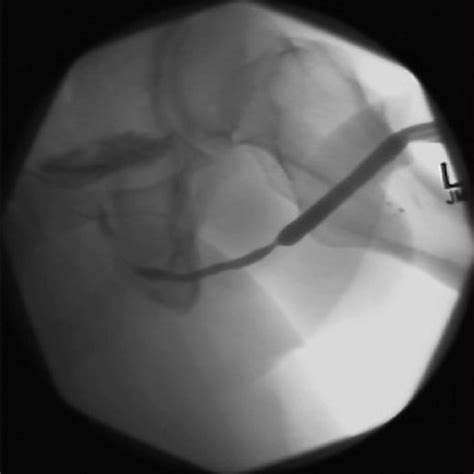 Preoperative Retrograde Urethrogram Showing Bulbar Urethral Stricture