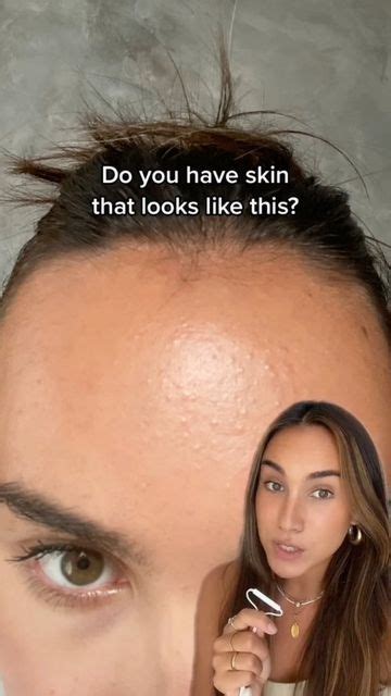 How To Treat Fungal Acne Tiny Bumps On Forehead Artofit