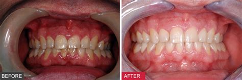 Healthy Gums Vs Gingivitis
