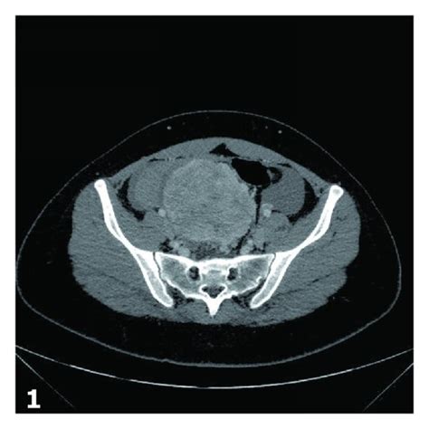 Computed Tomography Scan There Is A Large Irregular Heterogeneous