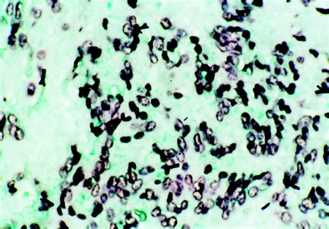 Intrahepatic Cholangiocarcinoma With Lymphoepithelioma Like Carcinoma Component