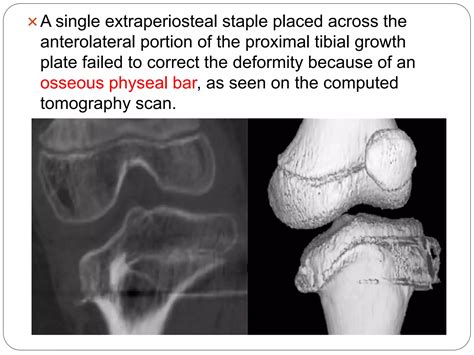 Physiological And Pathological Tibia Vara Ppt