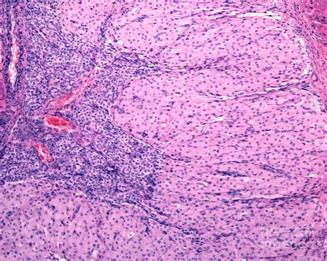 Corpus Albicans Histology
