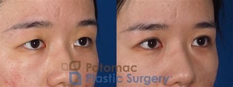 Double Eyelid Surgery In Young Woman By Dr Chaboki