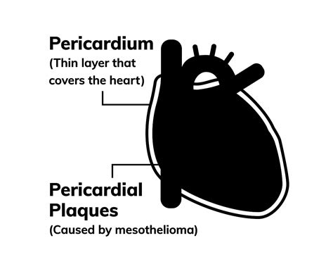 Malignant Mesothelioma Cancer Stages Prognosis Treatment