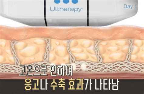 울쎄라 리프팅의 원리효과방법과주기부작용