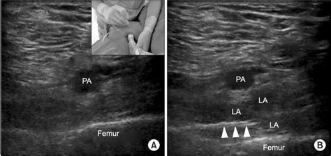 Ultrasound Images Demonstrating Relevant Sono Anatomy For The