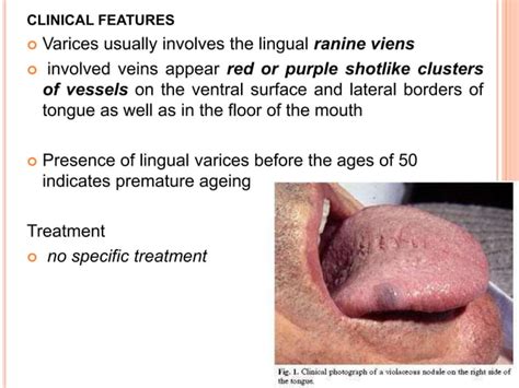Developmental Disturbances Of Tongue Pptx