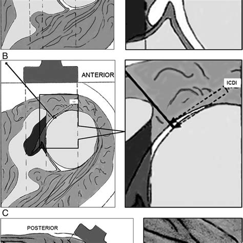 In Rotator Interval A B And Posterior E Techniques Of Injection