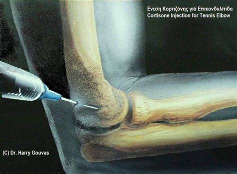 Lateral Epicondyle Injection