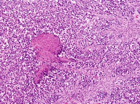 Histopathological Aspects Of Case 3 Tumors A Gastric Gist Mixed