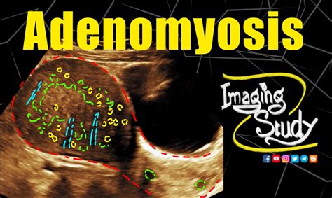 Case 119 Adenomyosis Uterus Ultrasound ~ Imaging Study