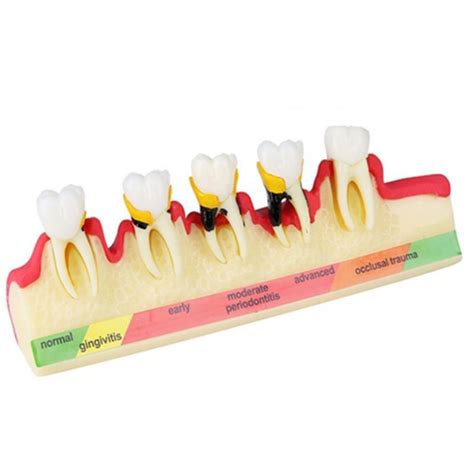 Periodontal Disease Teeth Model Dental Disease Model M4010 Caries Model Demonstrates The