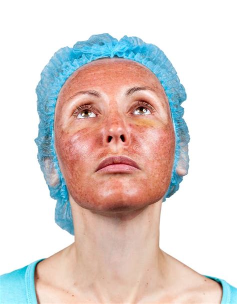 Cosmetology Chemical Peeling Boundary Between The Processed And Healthy Skin On A Neck Close
