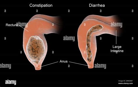 Comparison Diagram Of Constipation Vs Diarrhea In The Human Body Stock