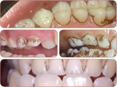Comment Enlever Des Taches Noires Sur Les Dents